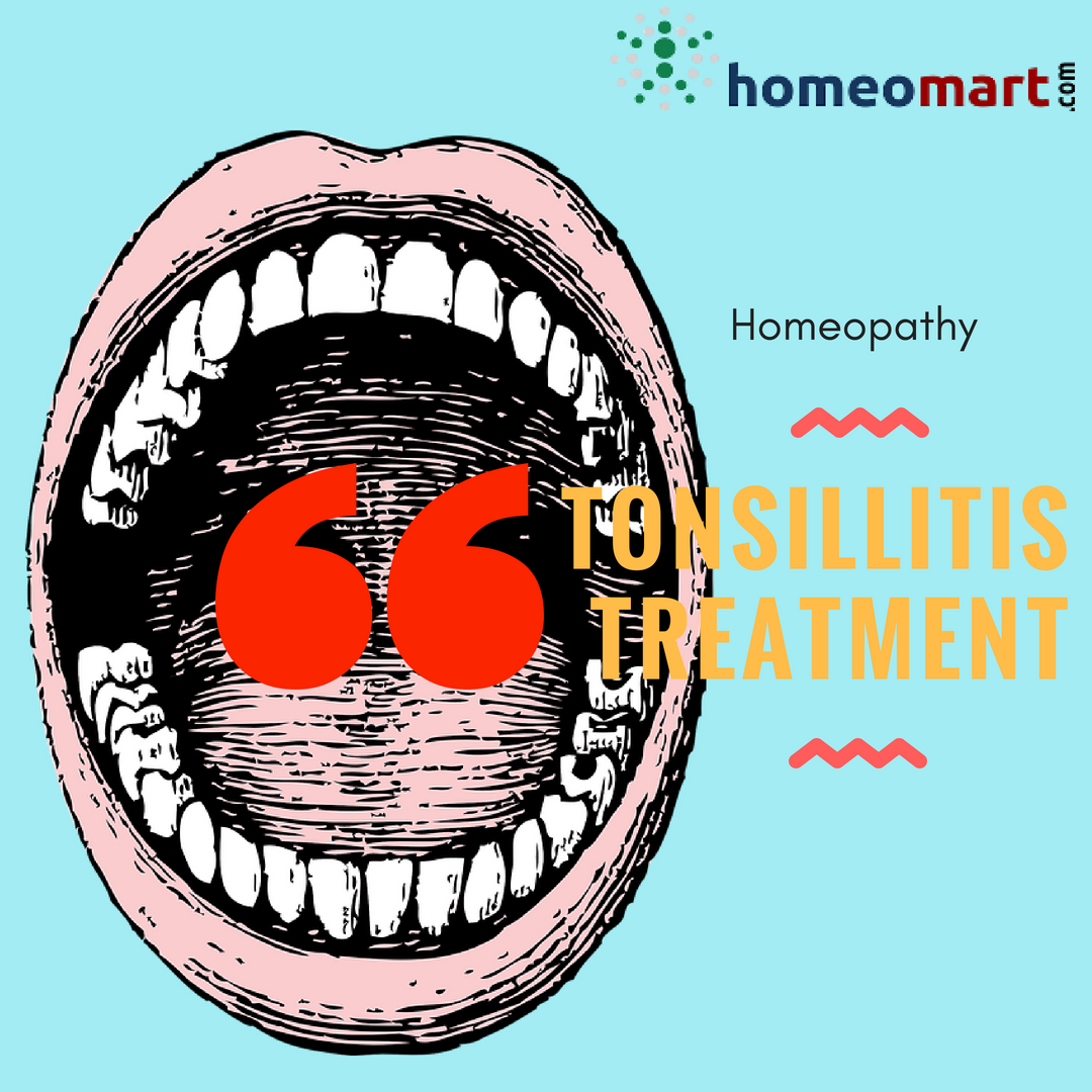 Top Homeopathy Medicines for Tonsillitis Treatment Online – Homeomart