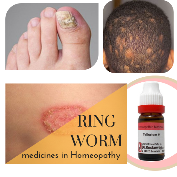 Top Homeopathic Medicines for Ringworm Infection – Safe & Effective ...