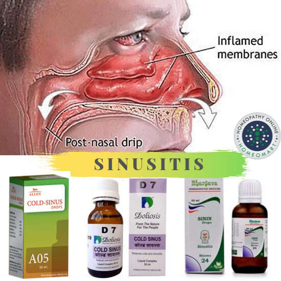 Best Homeopathy Medicines for Sinusitis - Comprehensive Treatment List ...